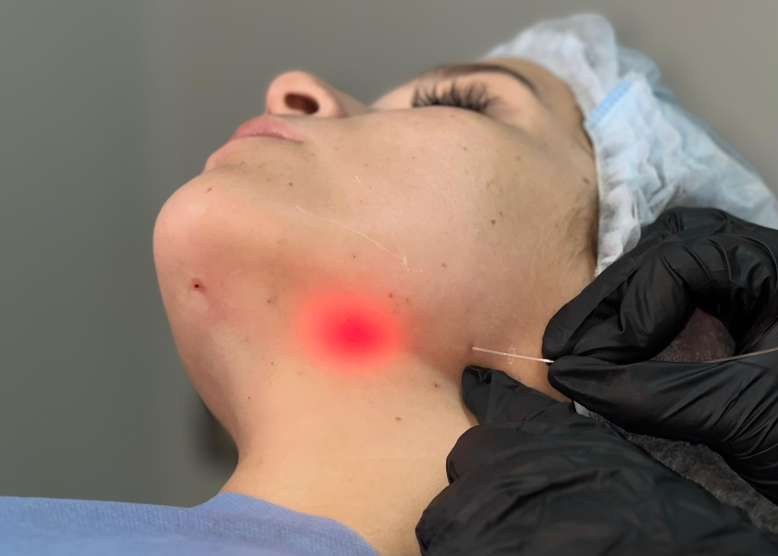 El endolifting, una alternativa para la belleza sin pasar por el ...
